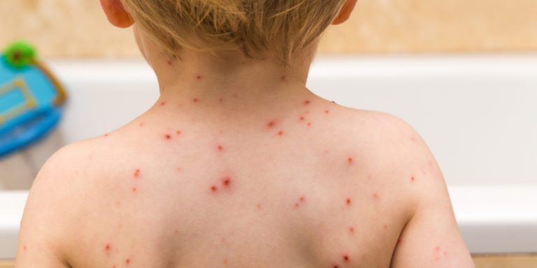 Su Çiçeği Başlangıcı Nasıl Olur? - İlk Belirtileri ve Yapılması Gerekenleri