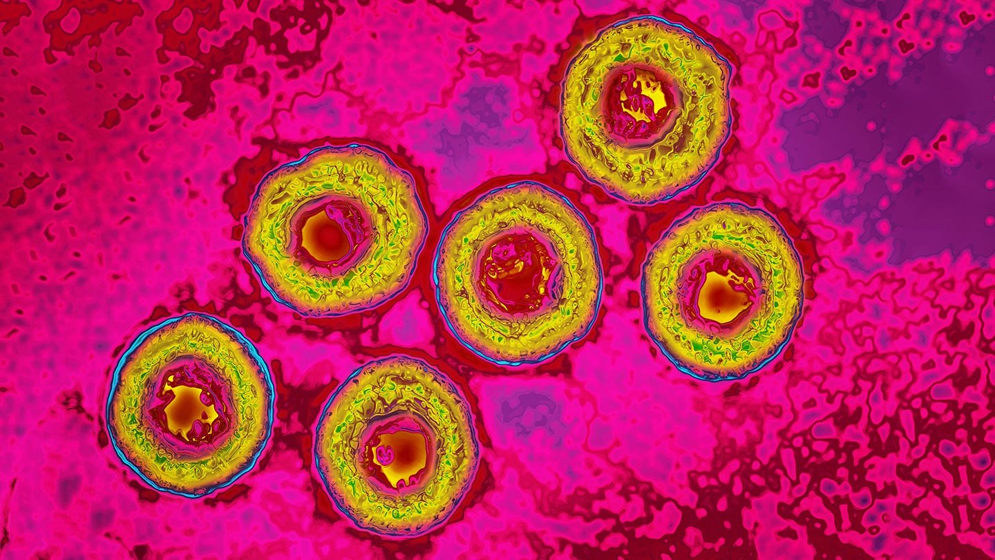 Zona Ağrısına Ne İyi Gelir? - Tedavi Yöntemleri ve Doğal Çözümleri